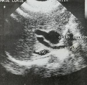 Chist de coledoc : Bolile cailor biliare