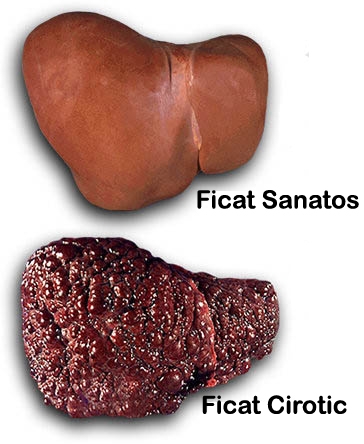 Ciroza hepatica : Bolile ficatului