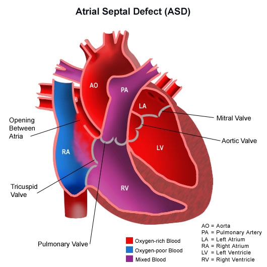 Defectul septal atrial : bolile aparatului cardio vascular la copii