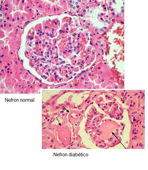 Nefropatia diabetica : NEFROLOGIE