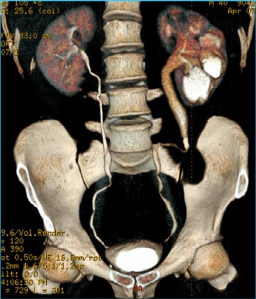 Pietrele la rinichi - (calculii) : Boli si tratamente
