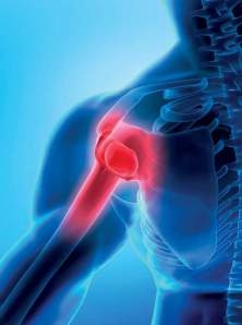 Reumatismul articular acut : reumatologie