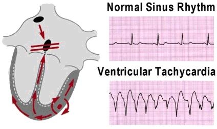 Tulburarile de ritm cardiac : bolile aparatului cardio vascular la copii