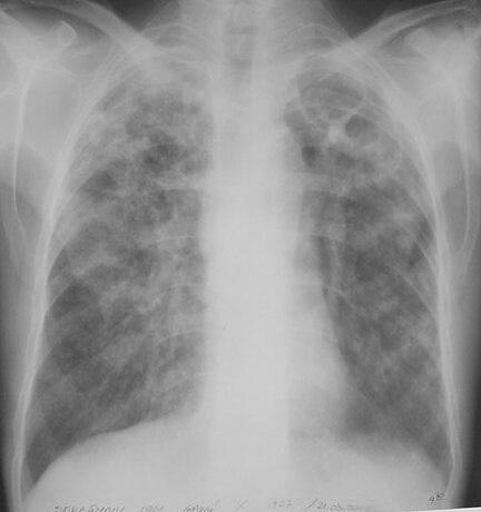Tuberculoza pulmonara : infectii respiratorii